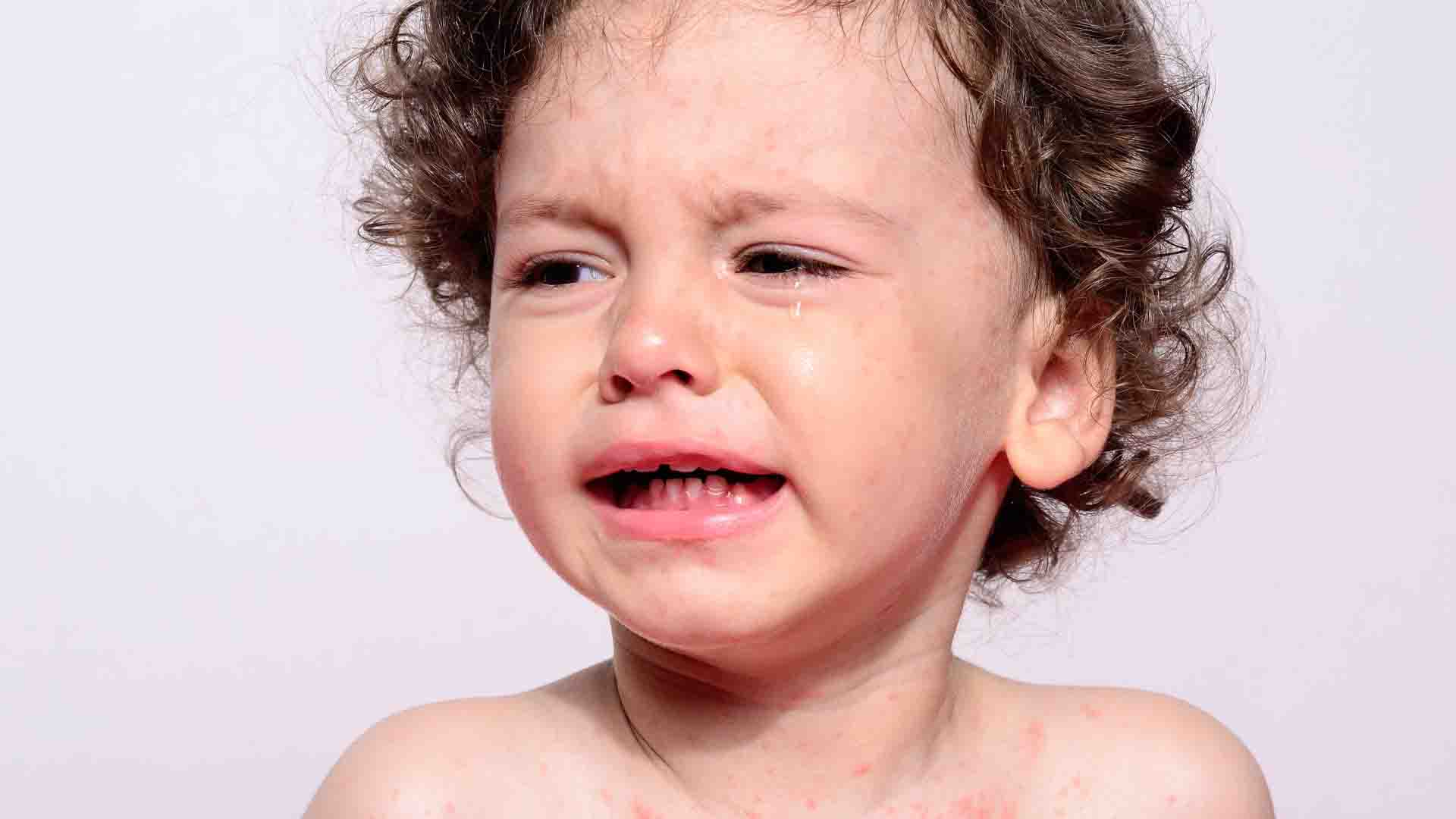 Qu'est-ce que la rubéole