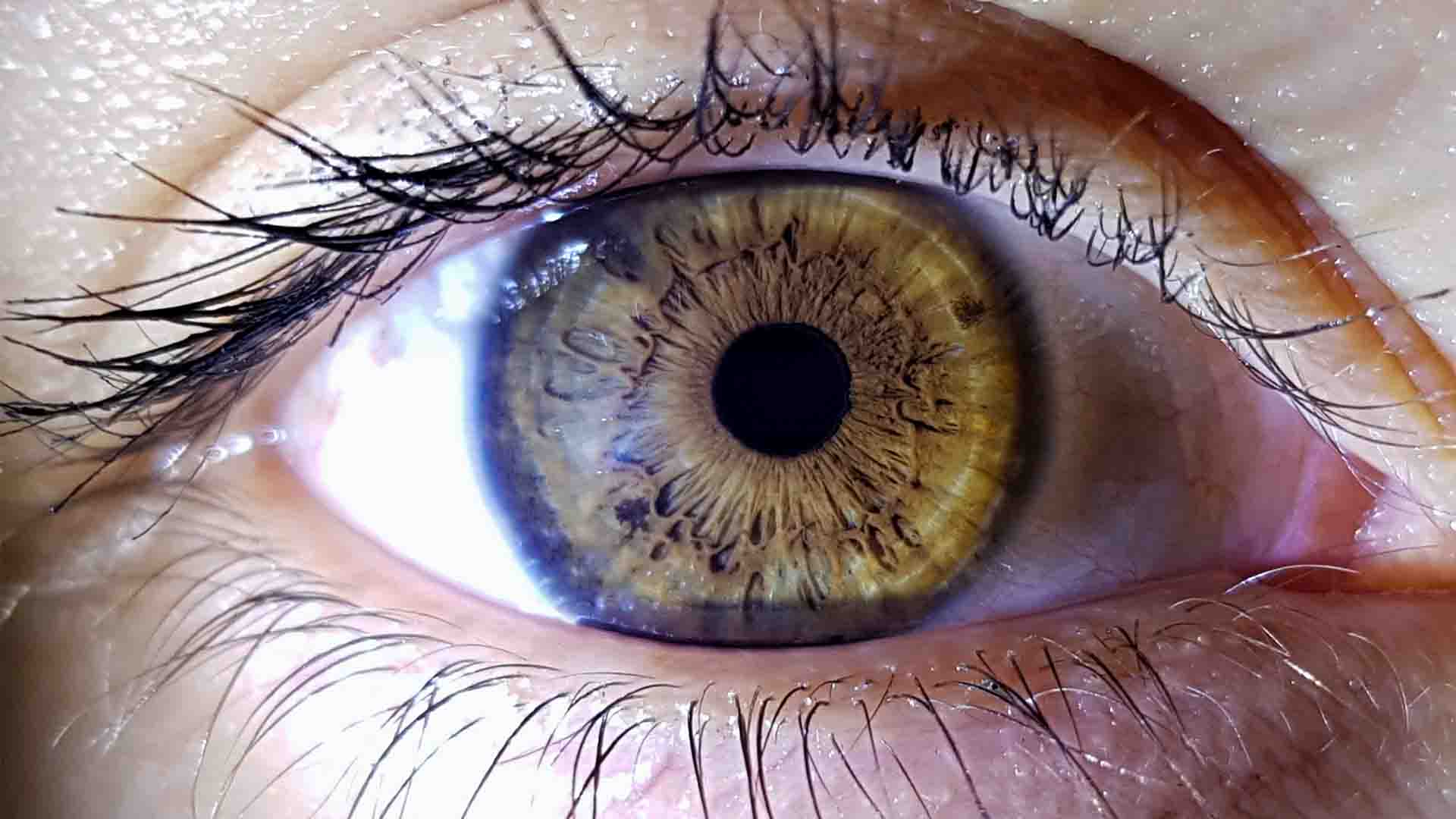 Comment soigner une uvéite